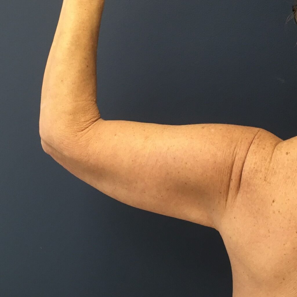 Arm Lift Archives - Associated Plastic Surgeons & Med Spa | Associated ...