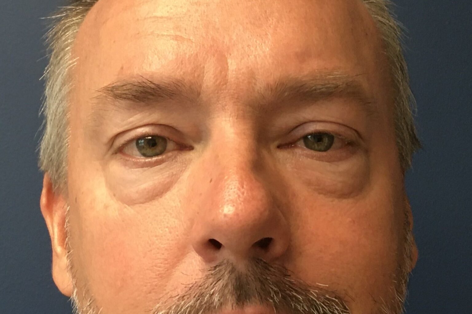 Blepharoplasty (Eyelid) Archives - Associated Plastic Surgeons