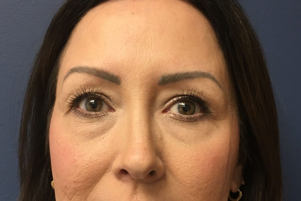 Blepharoplasty (Eyelid) Archives - Associated Plastic Surgeons